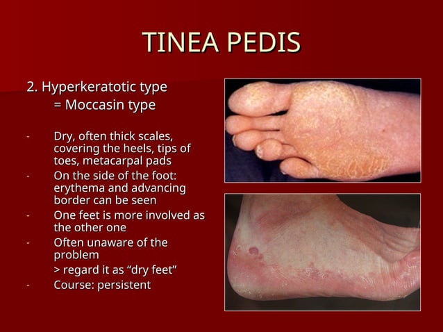 Superficial mycoses common in medical dermatology | PPT