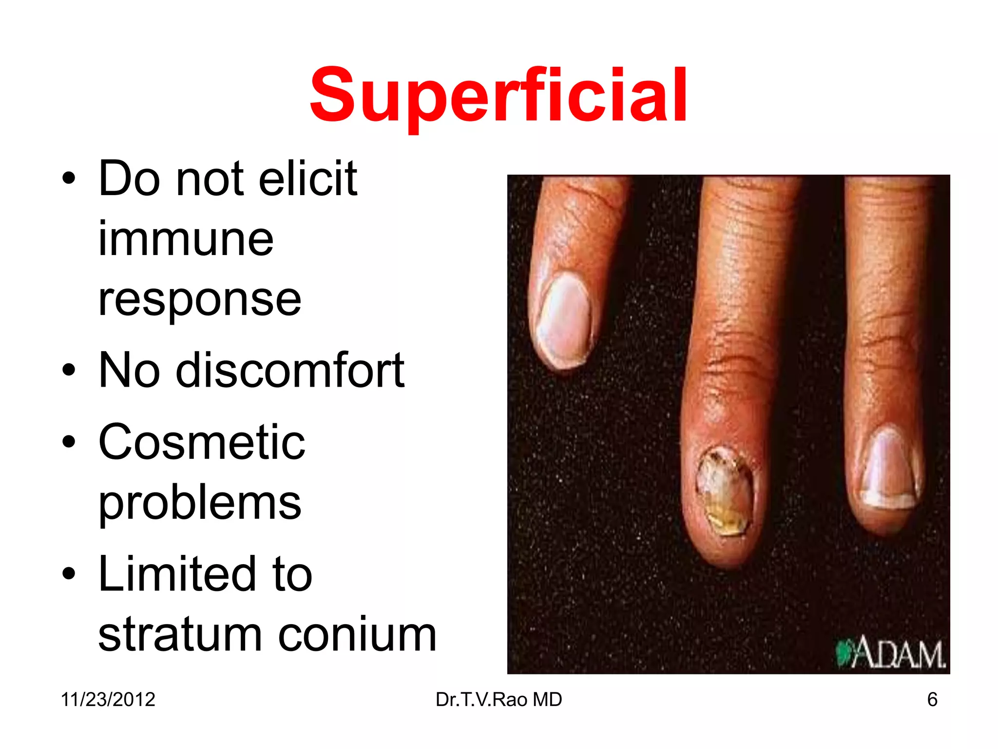 Superficial Fungal Infections | PPTX