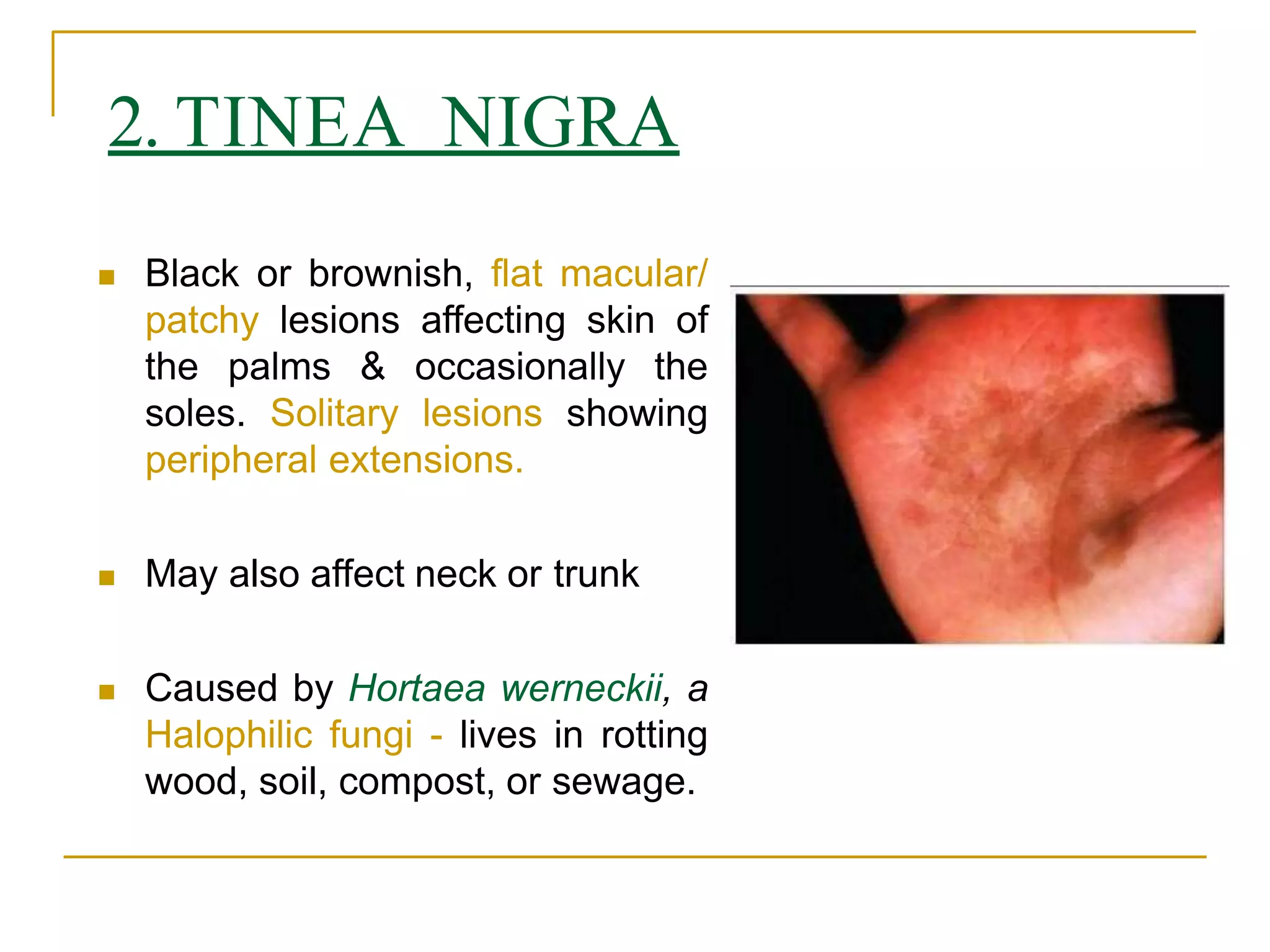 Superficial mycosis | PPTX
