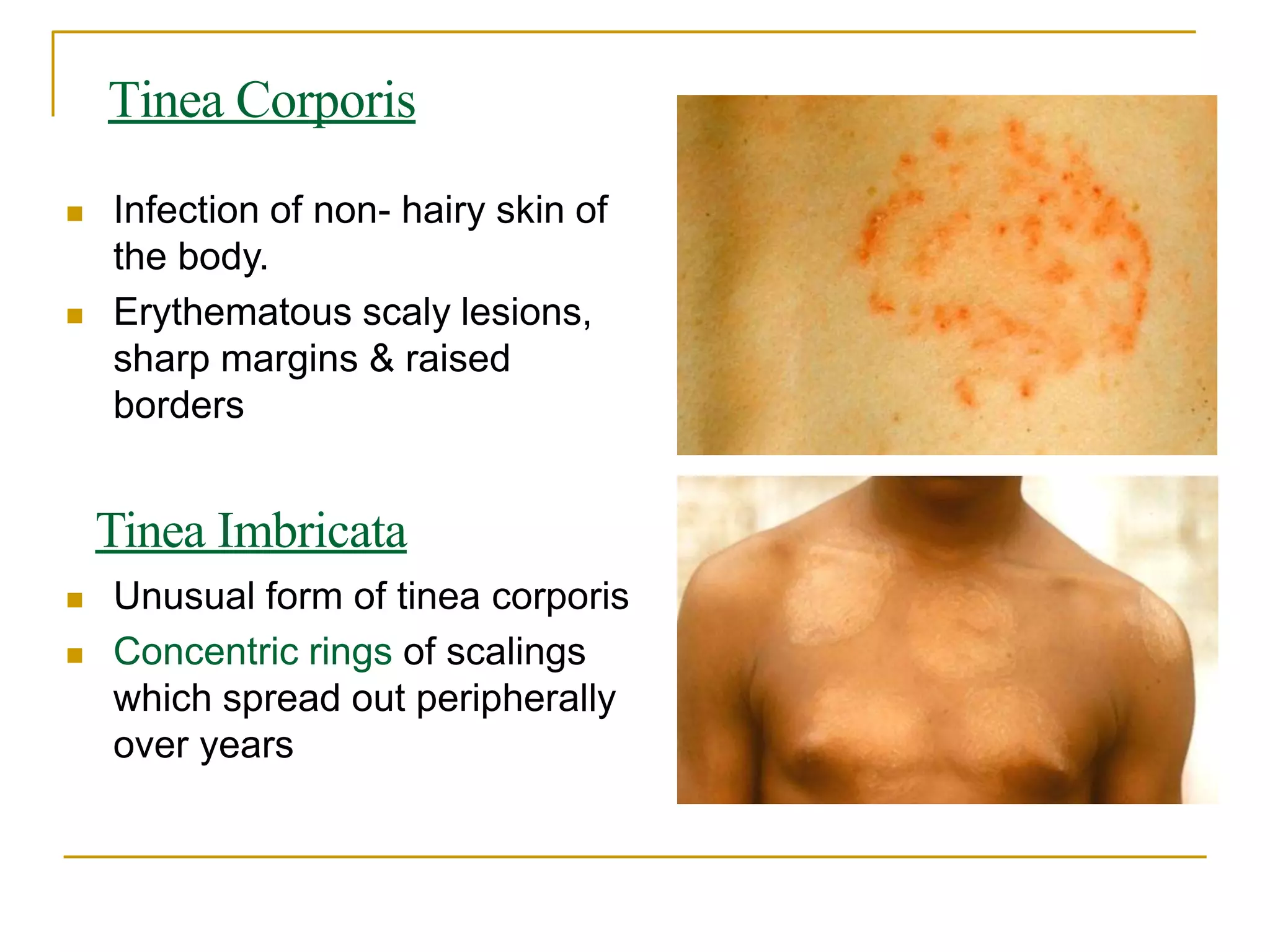 Superficial mycosis | PPTX