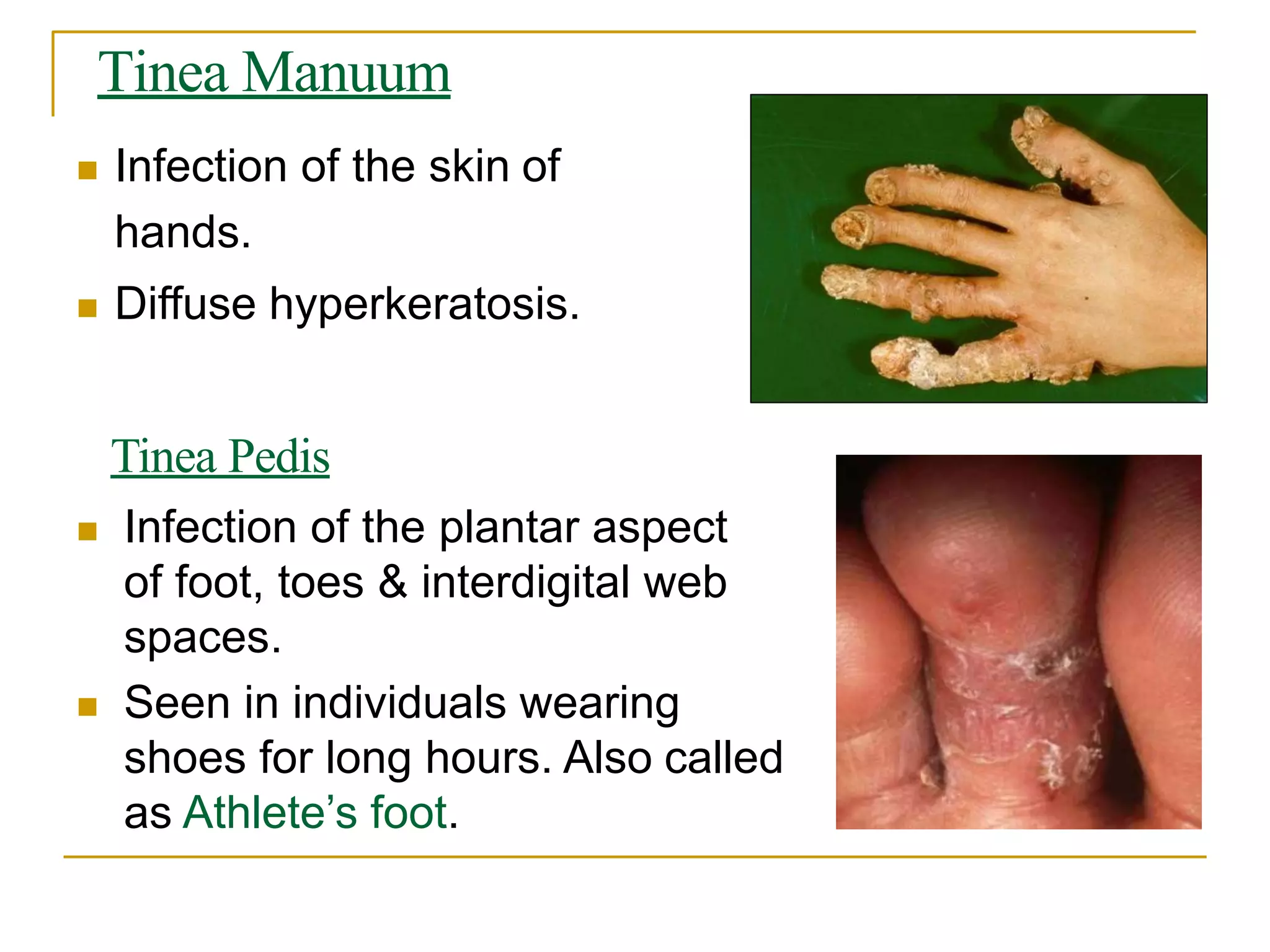 Superficial mycosis | PPTX
