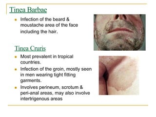Superficial mycosis | PPTX