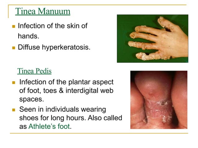 Superficial mycosis | PPTX | Skin and Dermatology | Diseases and Conditions