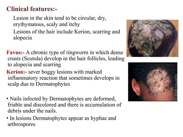 Superficial Mycosis.pptx