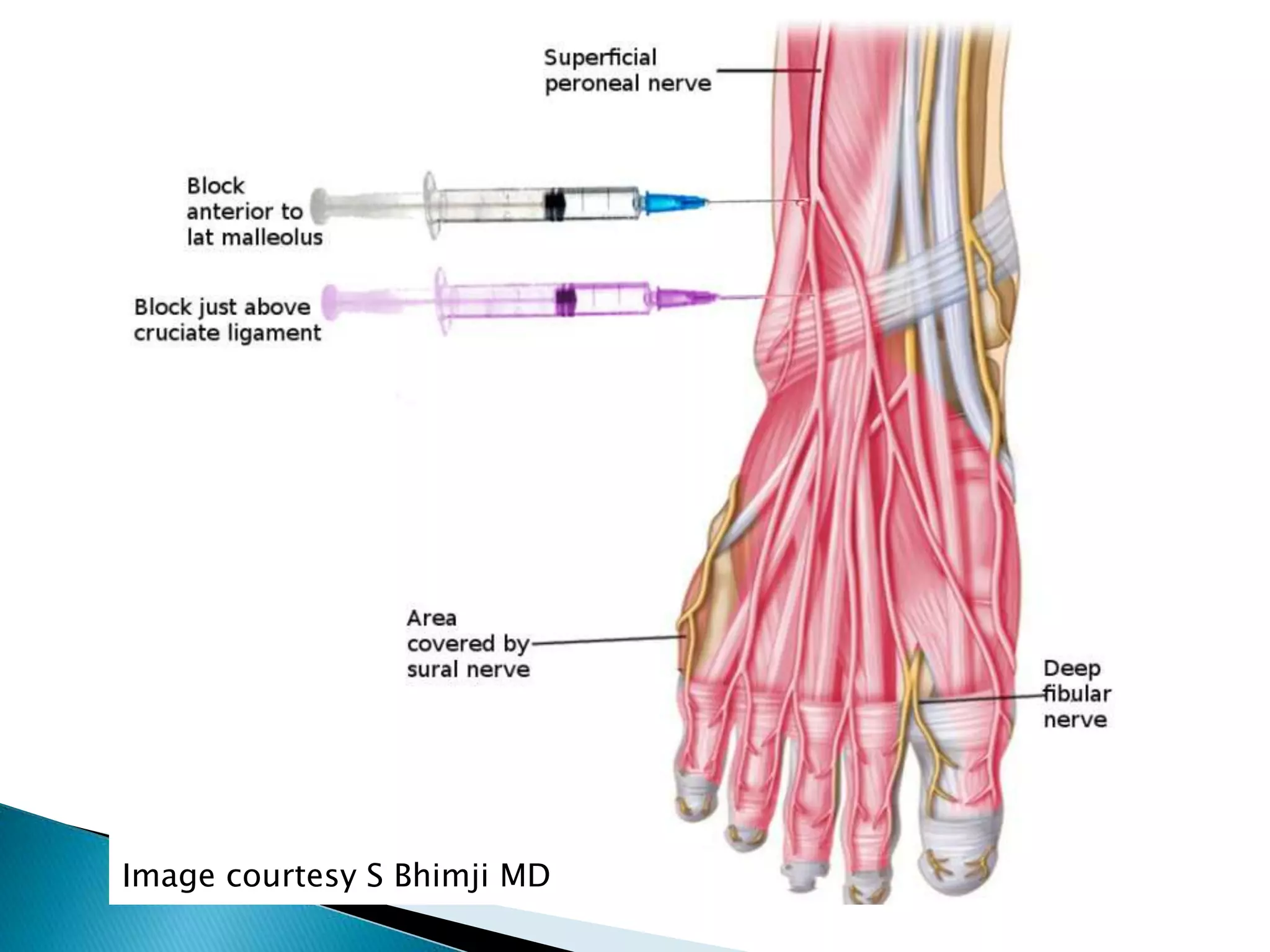 Superficial Peroneal Nerve Entrapment | PPTX | Death, Injury, or ...