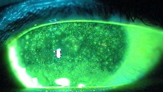SUPERFICIAL PUNCTATE KERATITIS.pdf