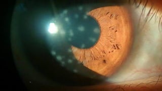 Superficial Punctate Keratitis