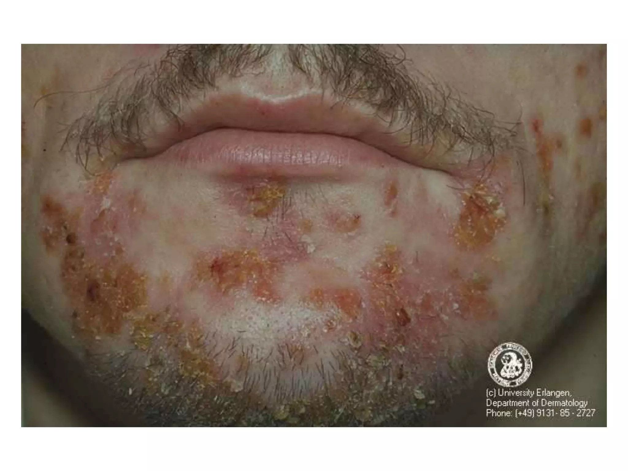 Superficial pyodermas by aseem | PPTX