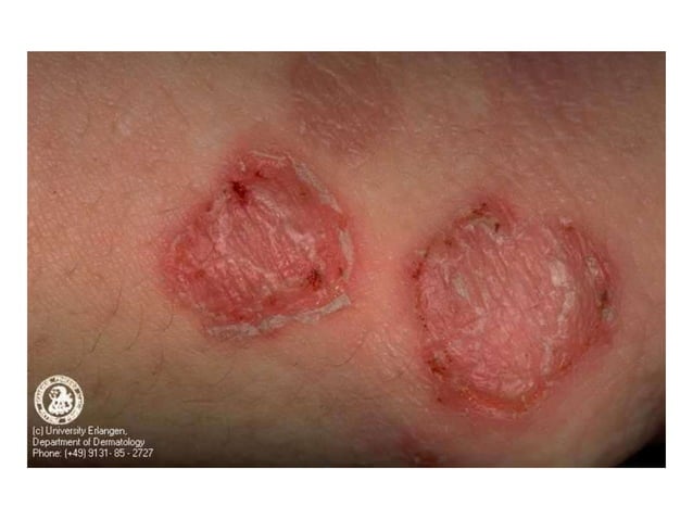 Superficial pyodermas by aseem | PPTX