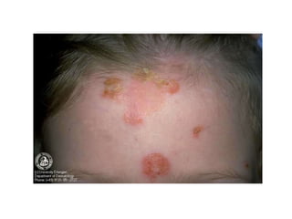 Superficial pyodermas by aseem | PPTX