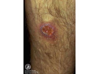 Superficial pyodermas by aseem | PPTX