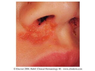 Superficial pyodermas by aseem | PPTX