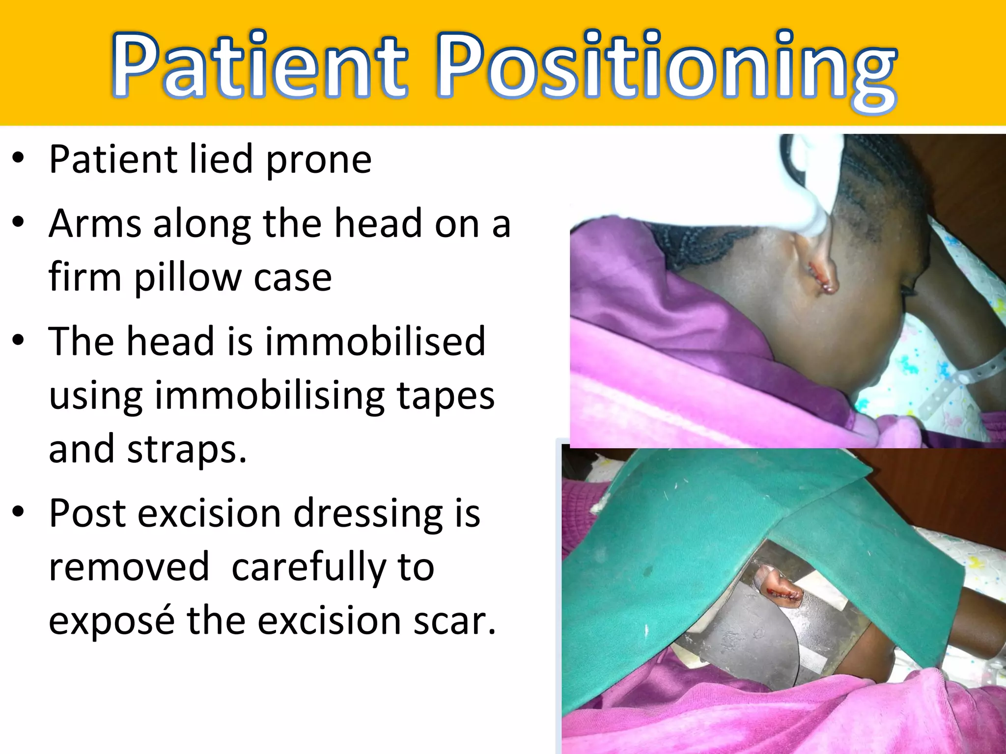 Superficial radiotherapy (sxt)_following_ear_lobe | PPT