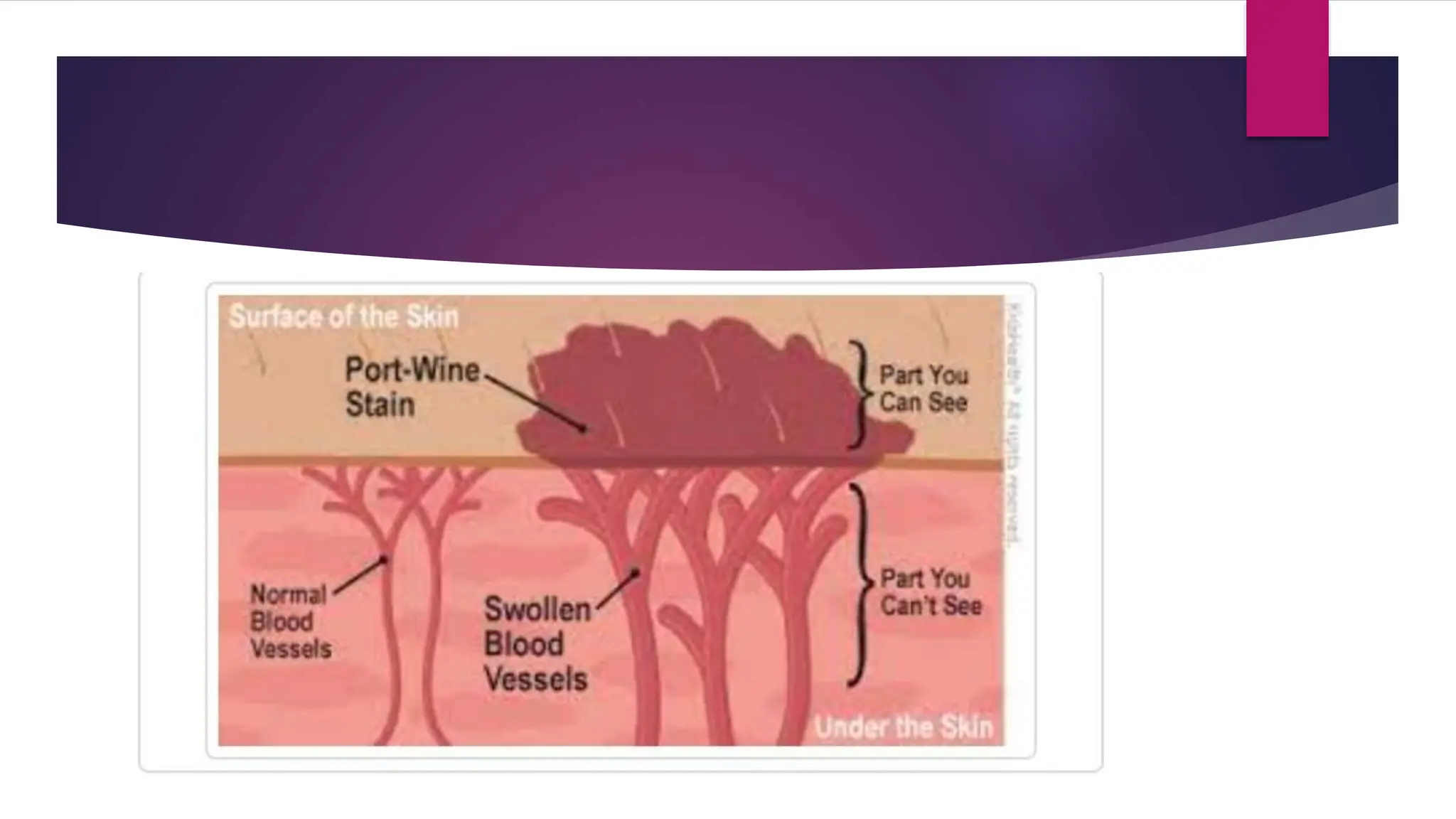 SUPERFICIAL SOFT TISSUE SWELLING IN PAEDIATRICS.pptx