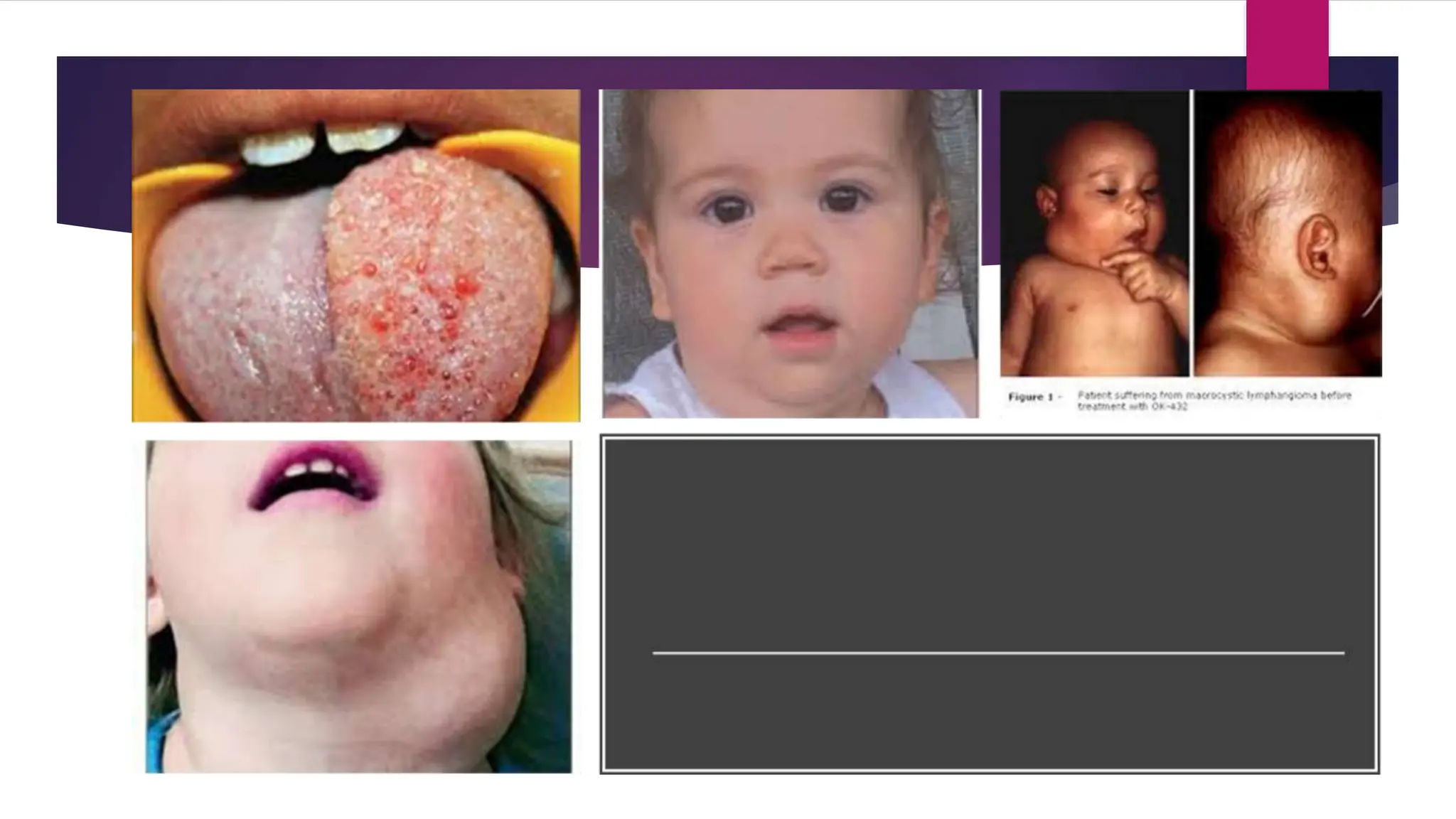 SUPERFICIAL SOFT TISSUE SWELLING IN PAEDIATRICS.pptx