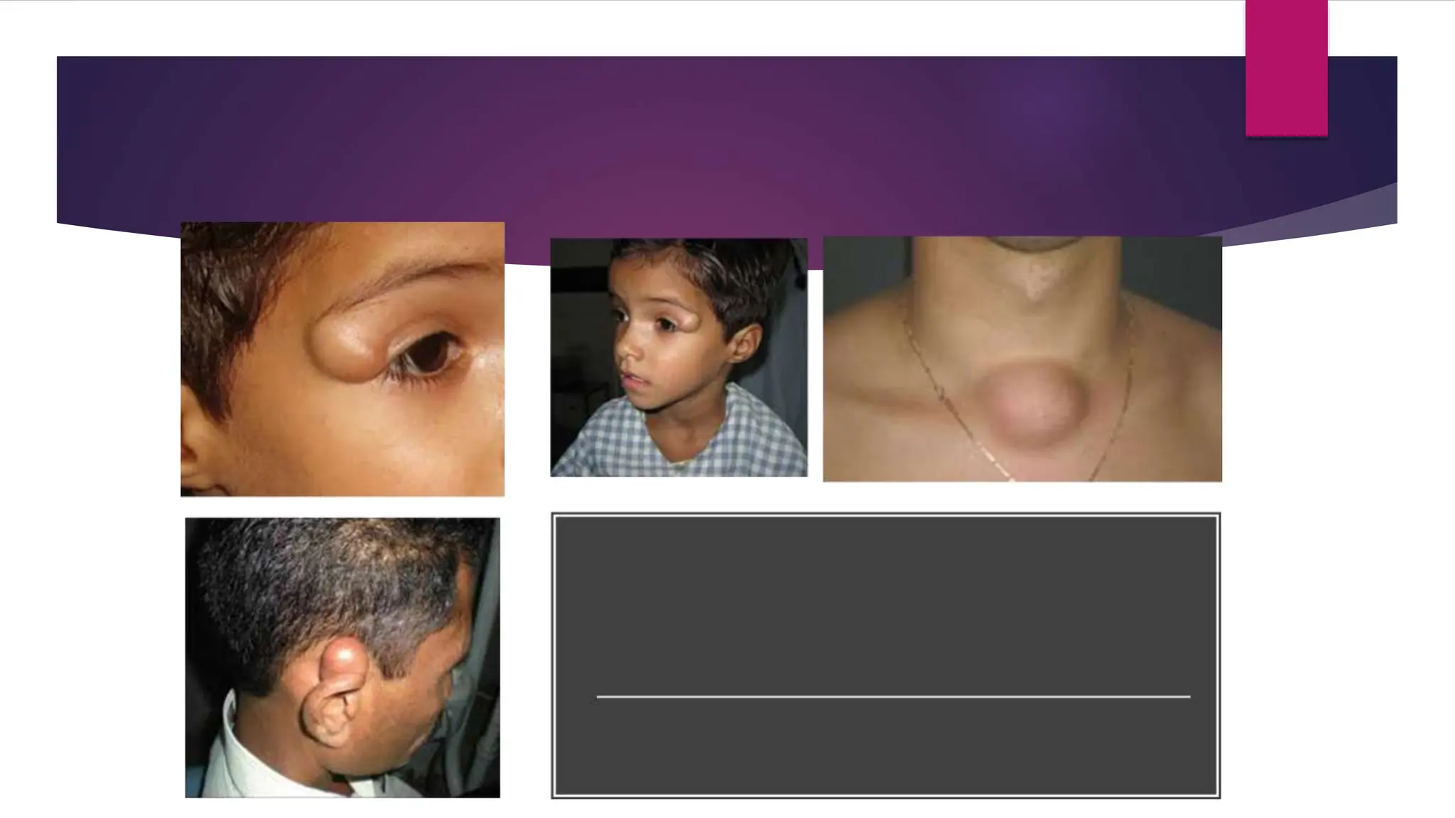 SUPERFICIAL SOFT TISSUE SWELLING IN PAEDIATRICS.pptx