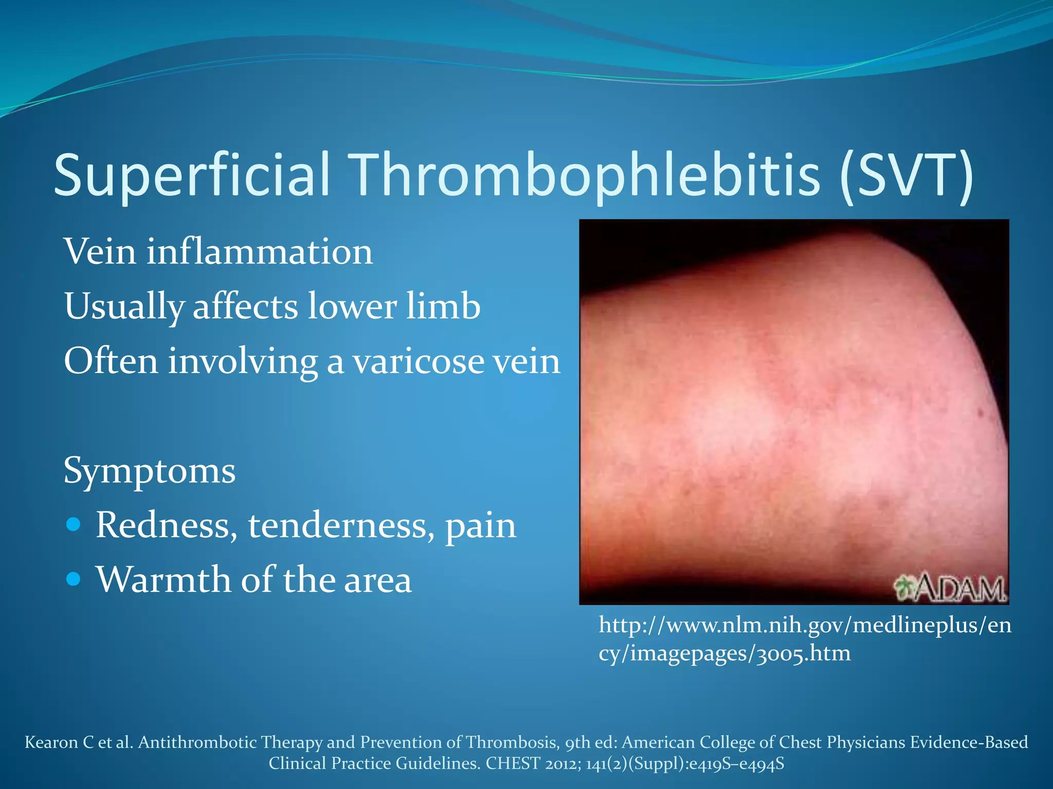 Superficial vein thrombosis | PPTX