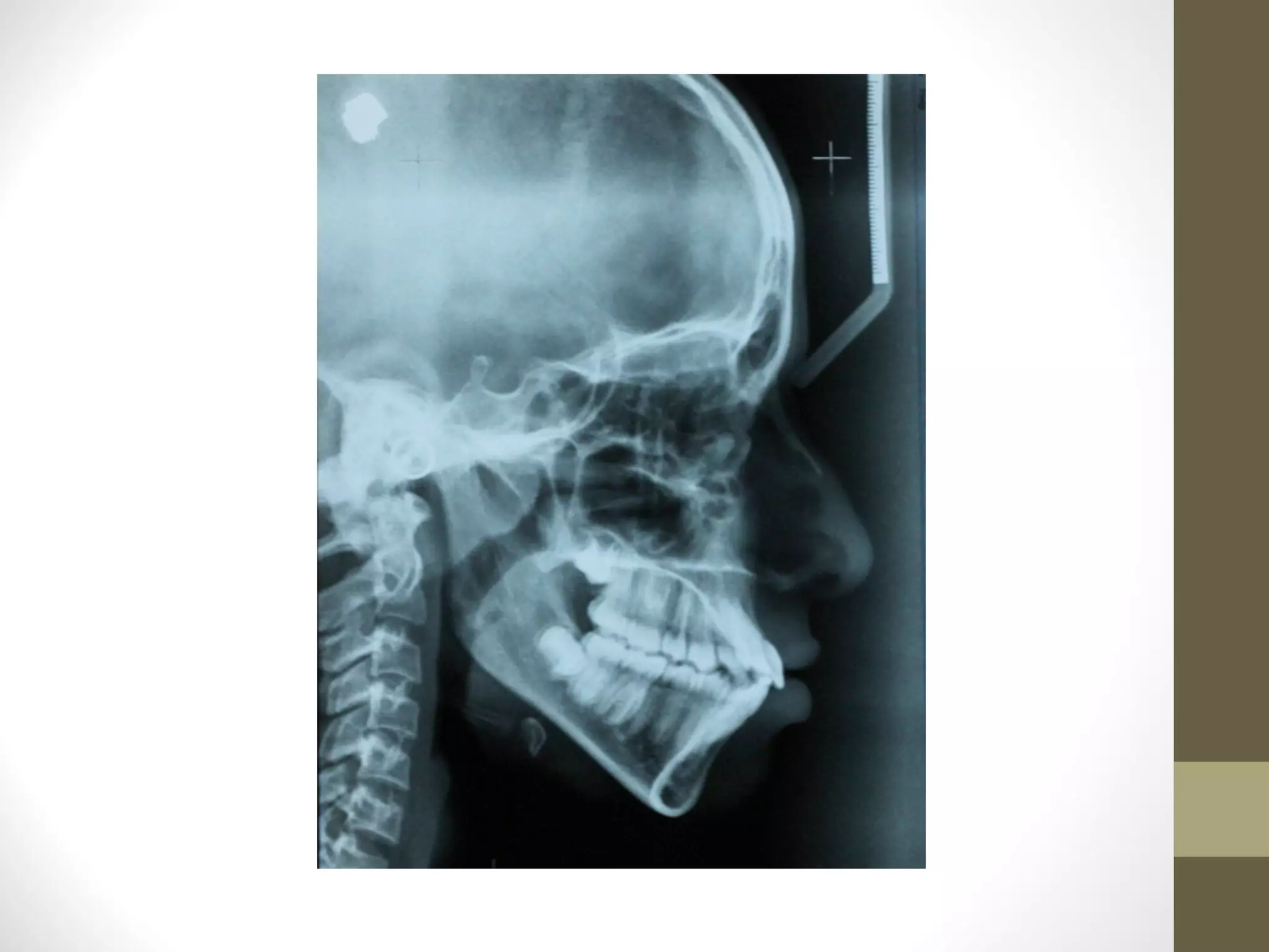 Superimposition techniques | PPT