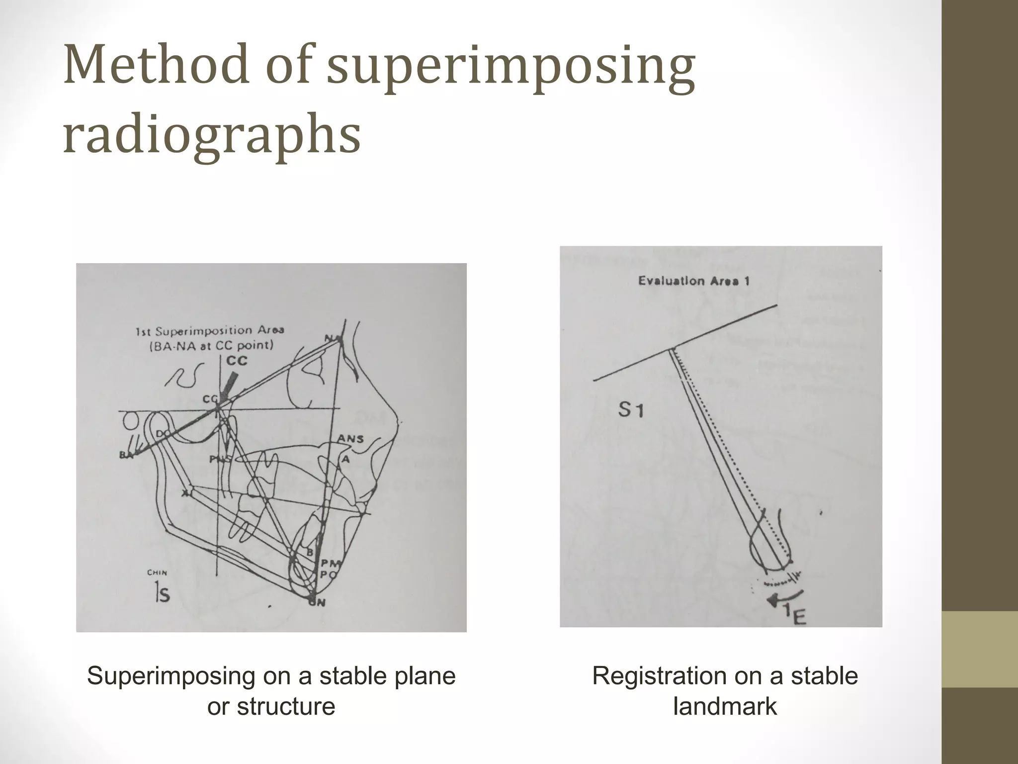 Superimposition techniques | PPT