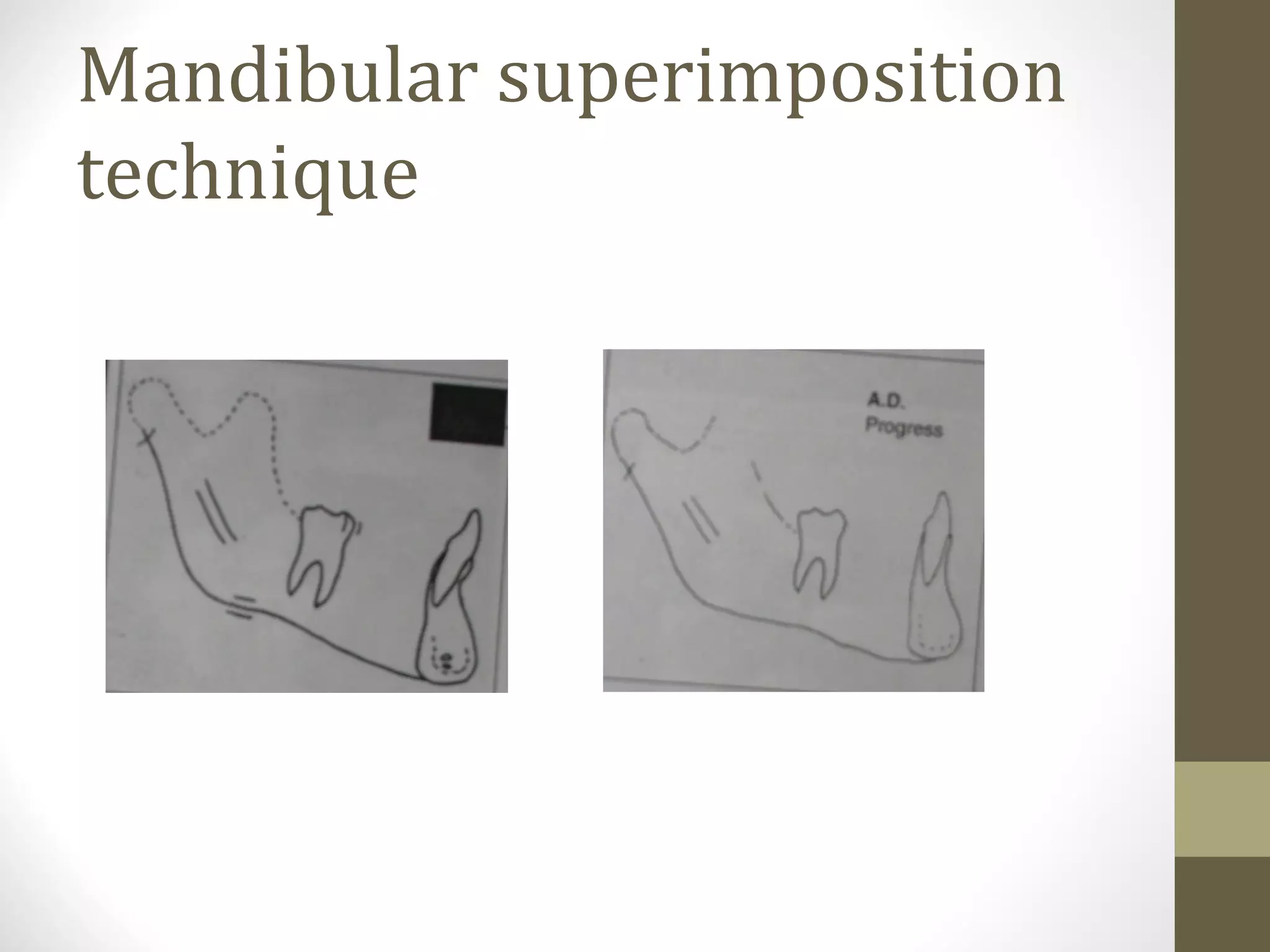 Superimposition techniques | PPT