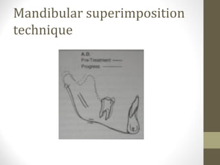 Superimposition techniques | PPT