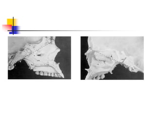 ORTHODONTICS SUPERIMPOSITION_TECHNIQUES.ppt