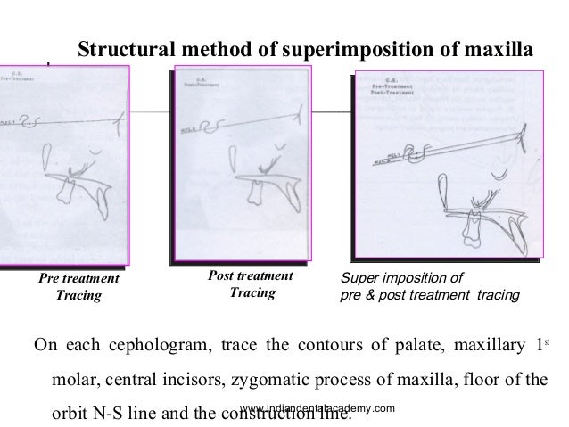 Superimposition techniques