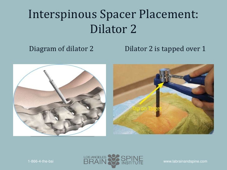 Interspinous Spacer New Interspinous Spacers Provide Drug-free Pain ...