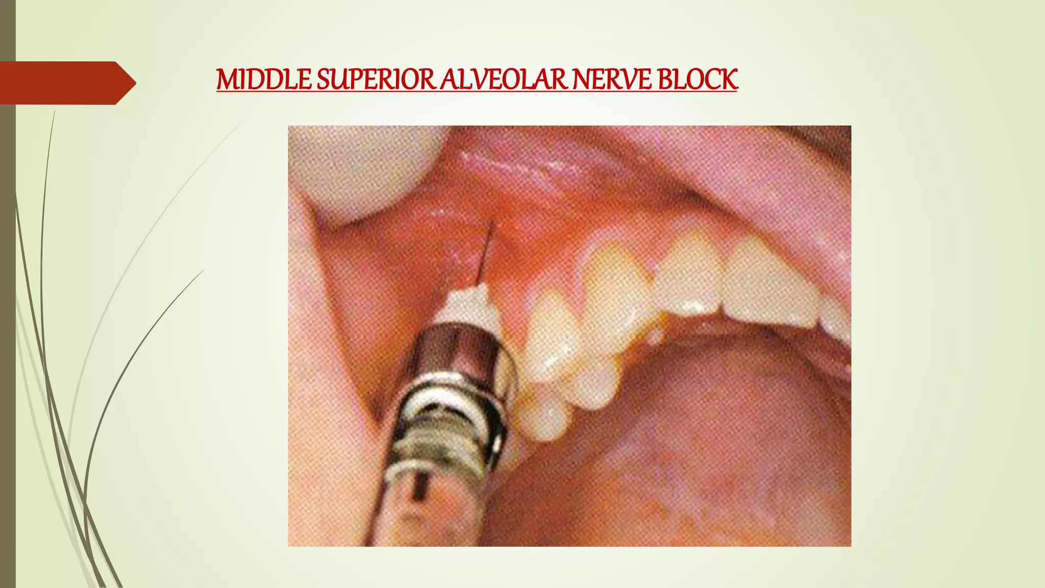 Superior Alveolar Nerve Block.pptx