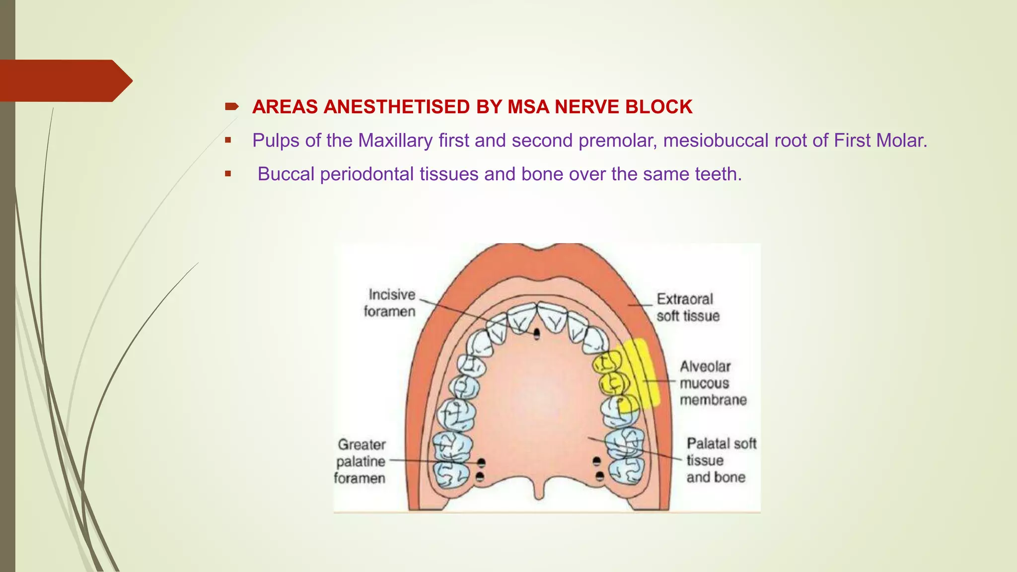 Superior Alveolar Nerve Block.pptx
