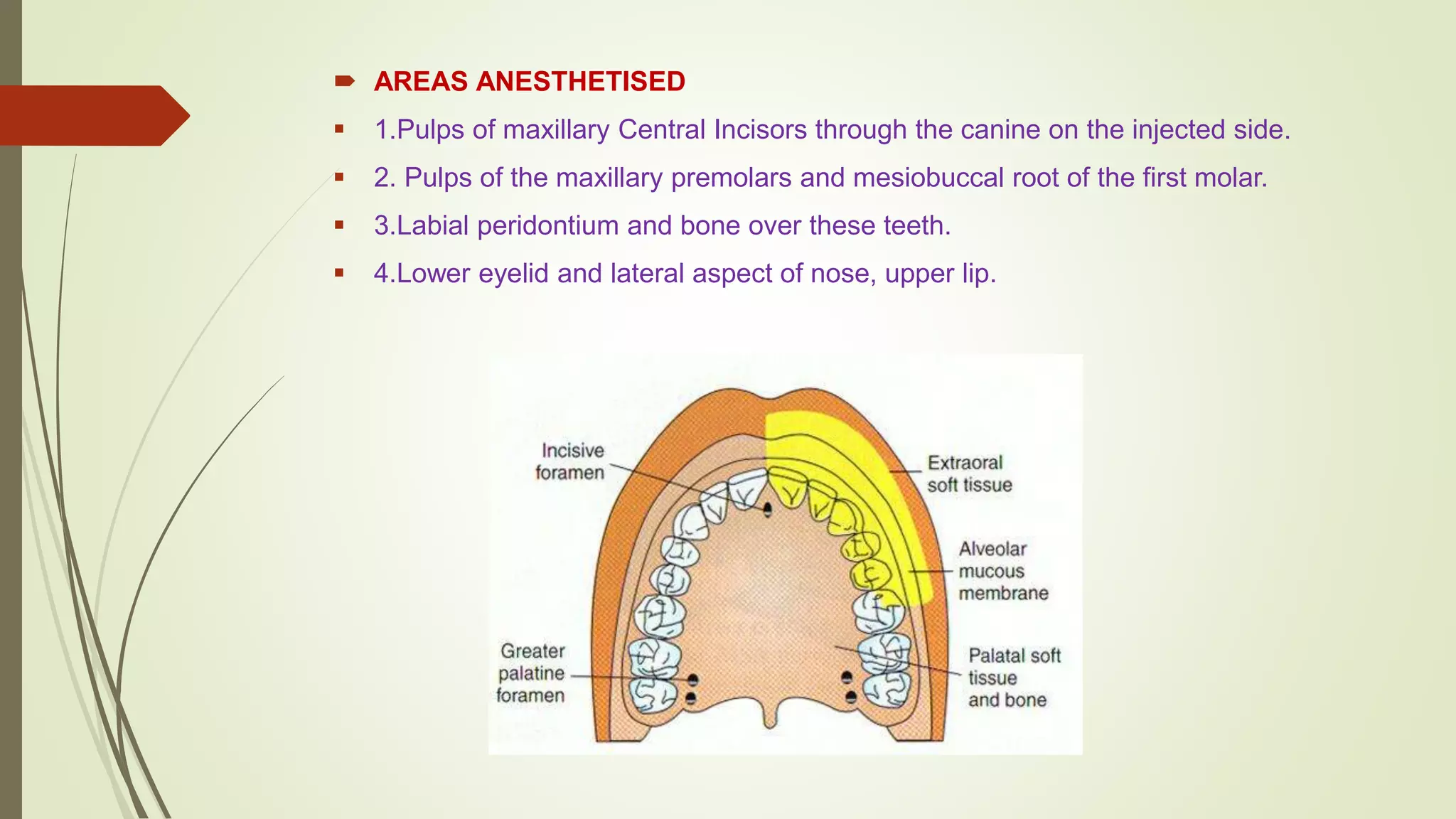 Superior Alveolar Nerve Block.pptx