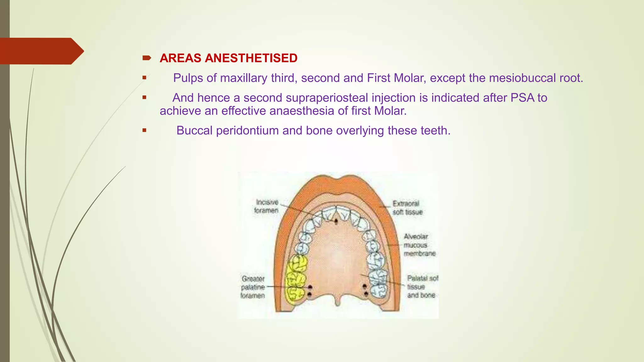Superior Alveolar Nerve Block.pptx