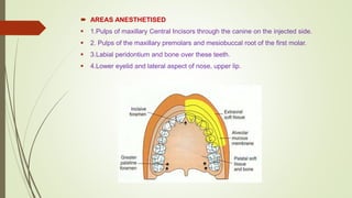 Superior Alveolar Nerve Block.pptx