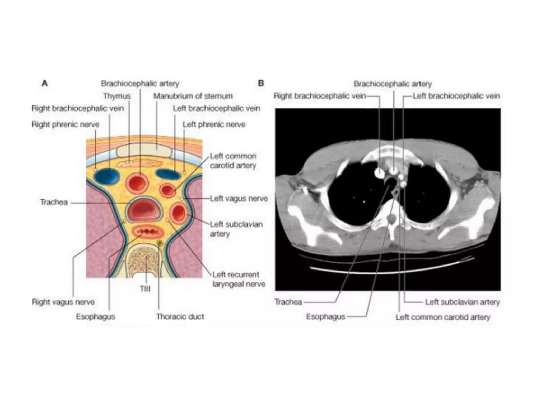 Superior mediastinum | PPTX