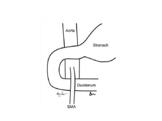 Superior mesenteric artery syndrome | PPTX