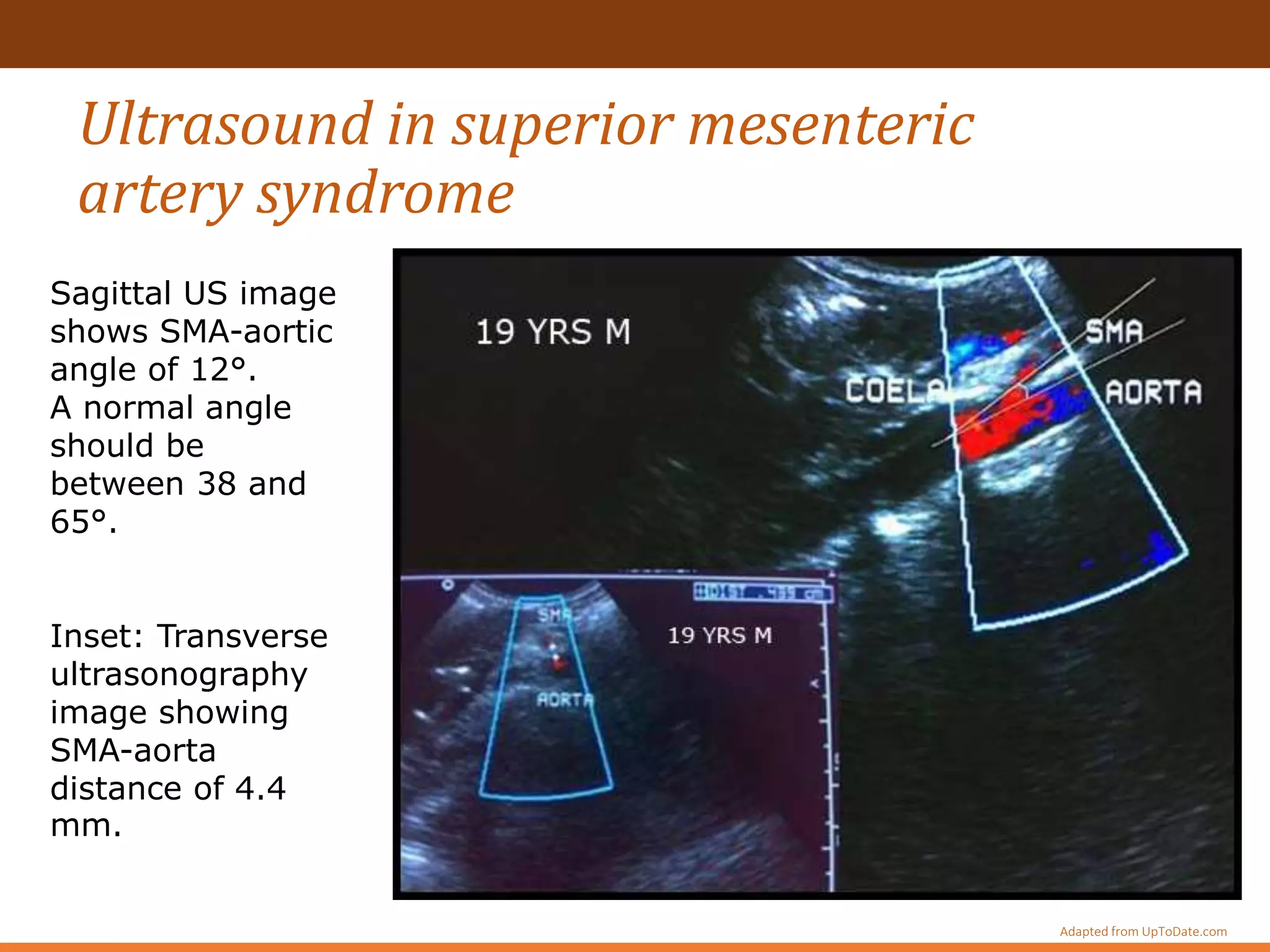 Superior mesenteric artery syndrome | PPTX