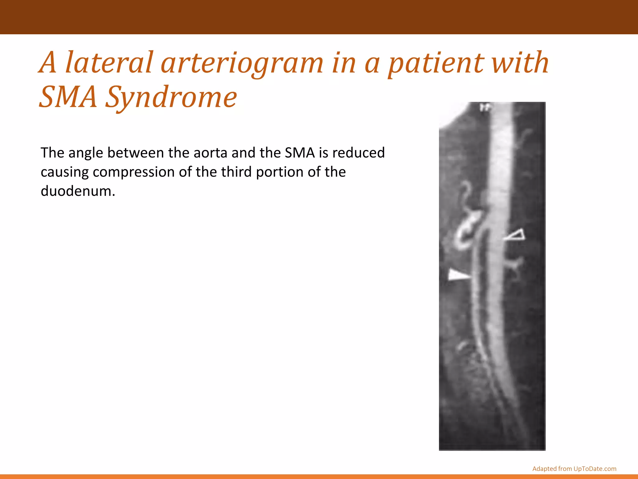 Superior mesenteric artery syndrome | PPTX