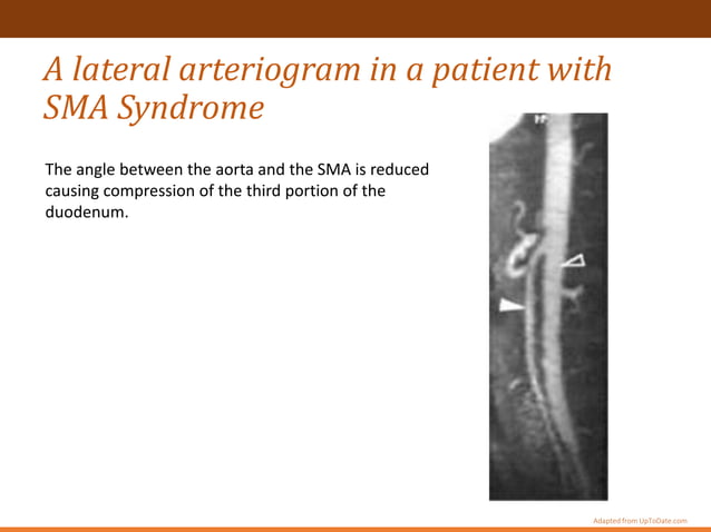 Superior mesenteric artery syndrome | PPTX | Digestive Disorders ...