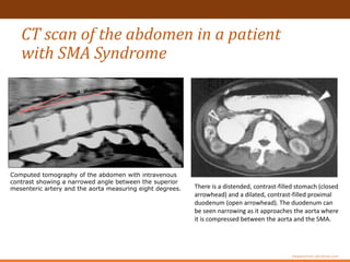 Superior Mesenteric Artery Syndrome Radiology