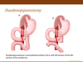 Duodenojejunostomy