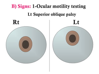 Superior oblique palsy | PPT