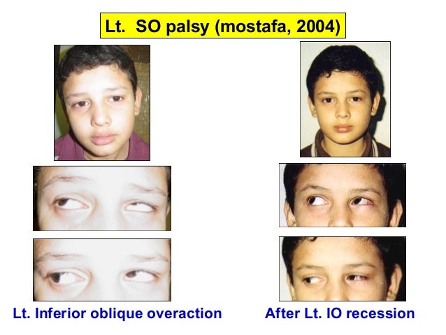 Superior oblique palsy