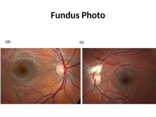 Left superior quadrantanopia case presentation | PPTX