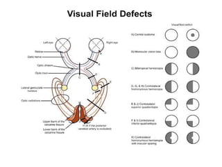 Left superior quadrantanopia case presentation | PPTX
