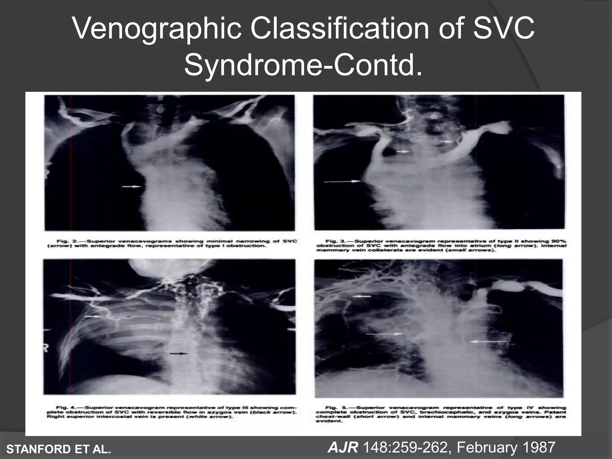 Superior vena cava syndrome | PPTX