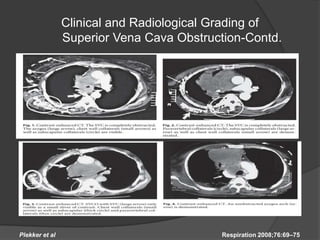 Superior vena cava syndrome | PPTX