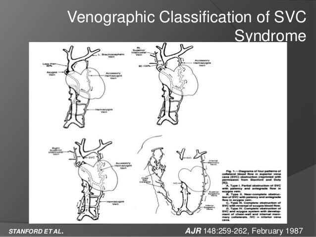 Superior vena cava syndrome