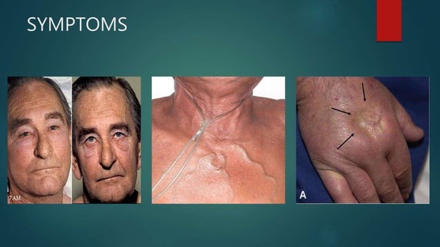 Superior vena cava syndrome | PPTX | Heart and Cardiovascular Diseases ...