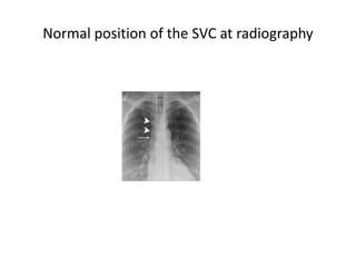 Superior vena cava syndrome | PPTX