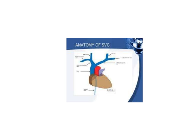 Superior vena cava syndrome | PPTX | Cancer | Diseases and Conditions